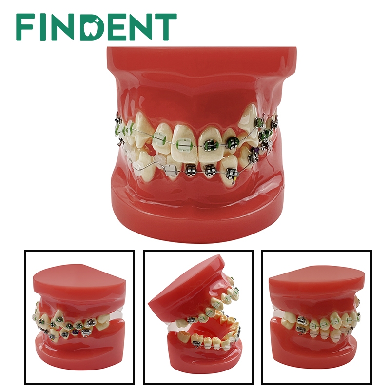 Dental Model Crowding Teeth Treatment Standard Teaching Model Dental ...