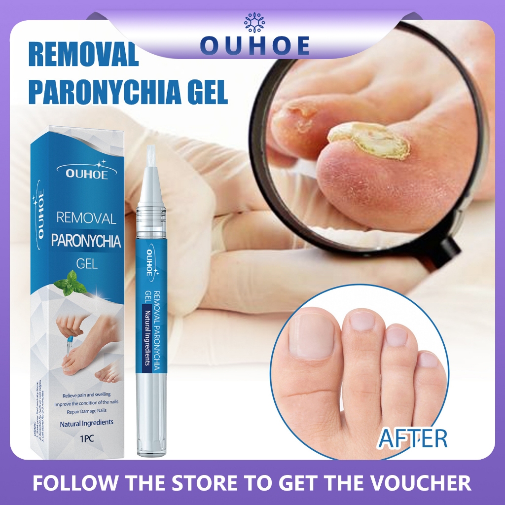Removal Paronychia Gel 1Pcs Anti-Fungal Nail Pen Repair Cracking Pain ...
