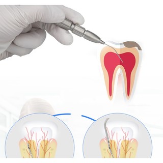 Dental Endodontic Endo File Removal System Kit / Endo Broken File ...