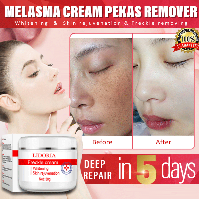 Whitening Freckle Cream Melasma Cream Pekas Remover Dark Spots Remover ...
