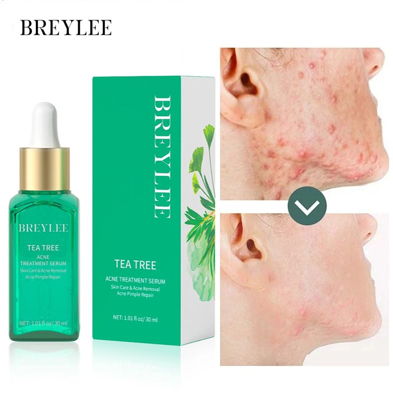 BREYLEE Tea Tree Acne Essence Treatment Inflamed Skin Moisturizing ...