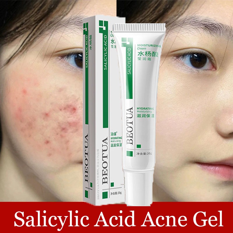 Salicylic Acid Acne Treatment Gel Ointment Pimple Remover Redness Skin ...