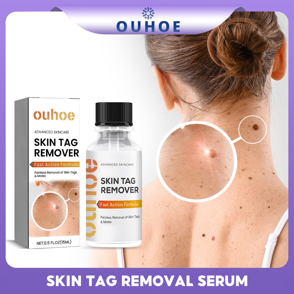OUHOE Skin Tag Remover Warts Removal Serum Clean Skin Warts Fade Moles ...