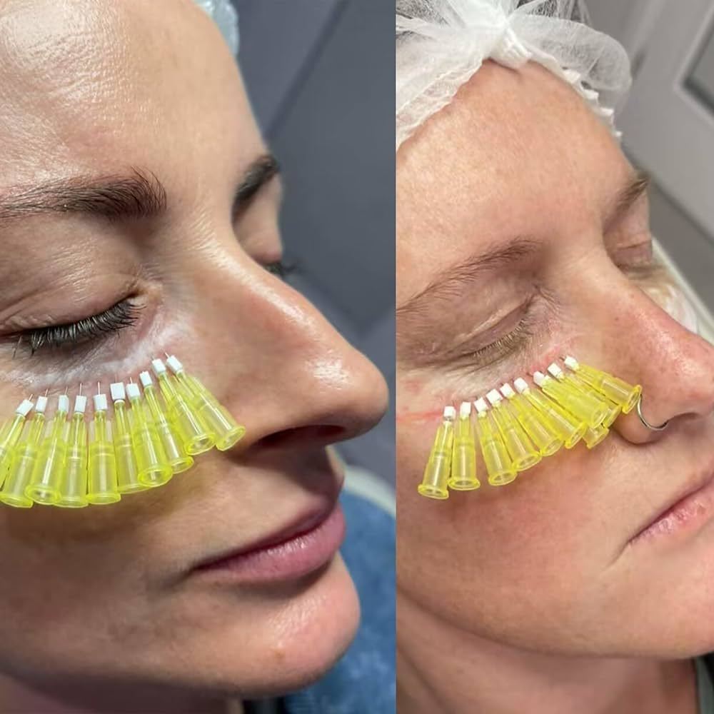 Minerva PDO Thread Lift Fox Eyes Mono Pdo Thread 30g 25mm Blunt Cannula for Under eye ...