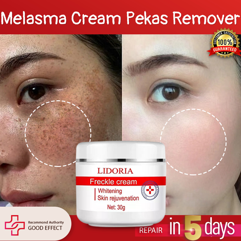 melasma cream pekas remover melasma cream peka dark spot remover ...