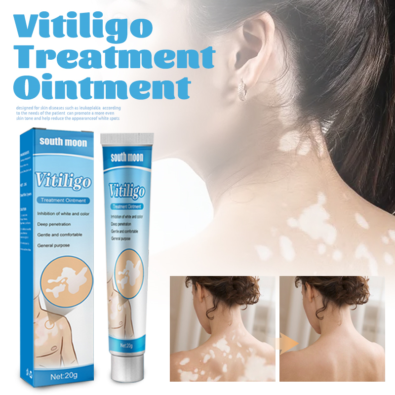 vitiligo treatment cream White Spots Tag / Kulugo Remover Cream First ...