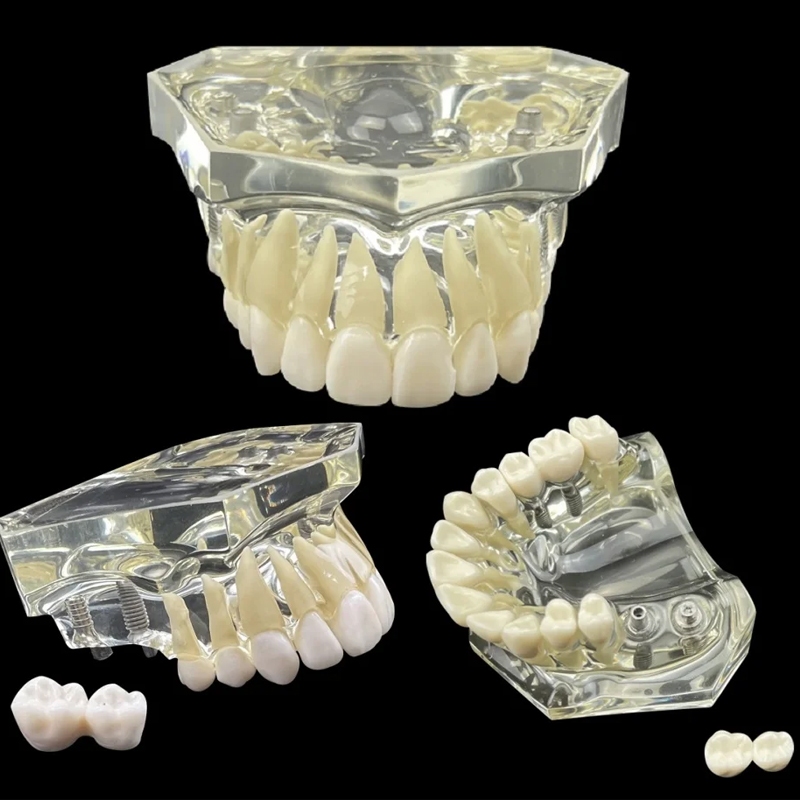 For Studying Teaching Education 4 Implants Restoration Dental Model ...