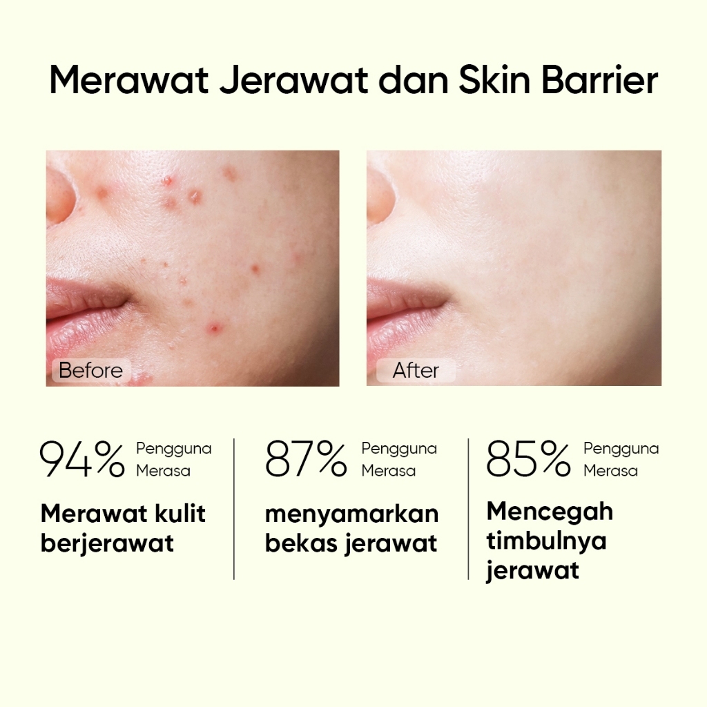 SADOER 3% Salicylic Acid Acne Treatment Serum Pimple Remover Anti Acne Marks Oil Control 30ml ...