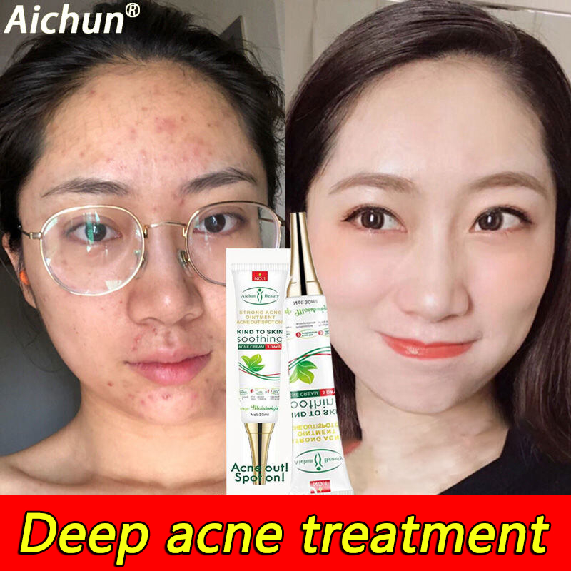 【FAST DELIVERY】Powerful Acne Removal Cream * Lighten Acne Marks ...