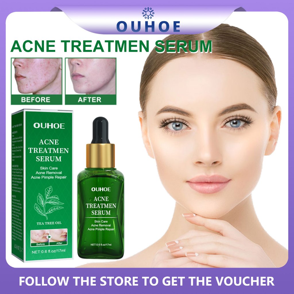 OUHOE Acne Treatmen Serum Acne Removal Essence Acne Pimple Repair Fade ...