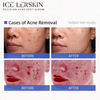 ICE LERSKIN Salicylic Acid Acne Essence Pimple Remover Acne Remover ...