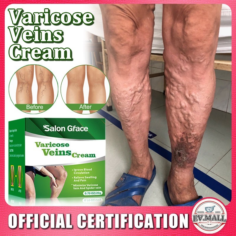 Varicose Vein Cream for Legs Improves Blood Circulation Reduces Spider ...