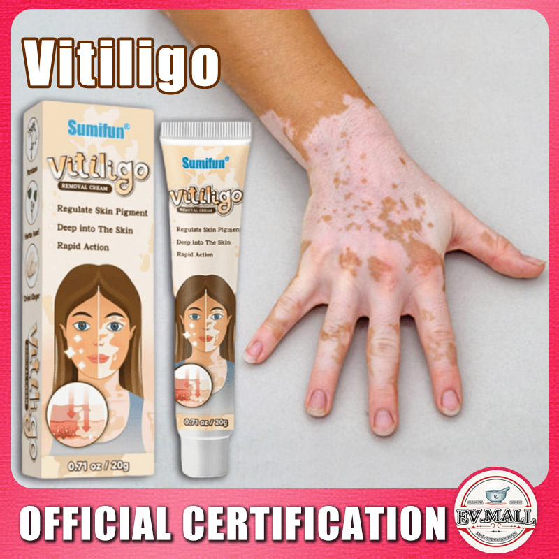 【READY STOCK】Vitiligo Cream Vitiligo Treatment Cream Herbal Formula For ...