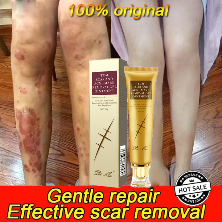 【Genuine】Tcm scar and acne mark removal gel ointment Remove scar gel ...