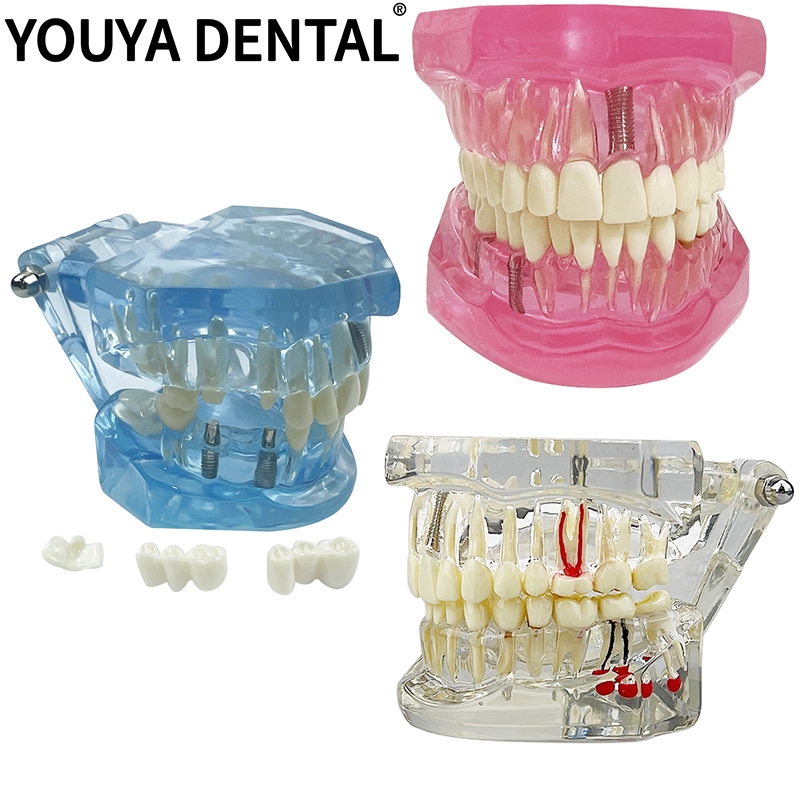 Dental Demonstrative Implant Teaching Bridge Teeth Study Model Tooth ...