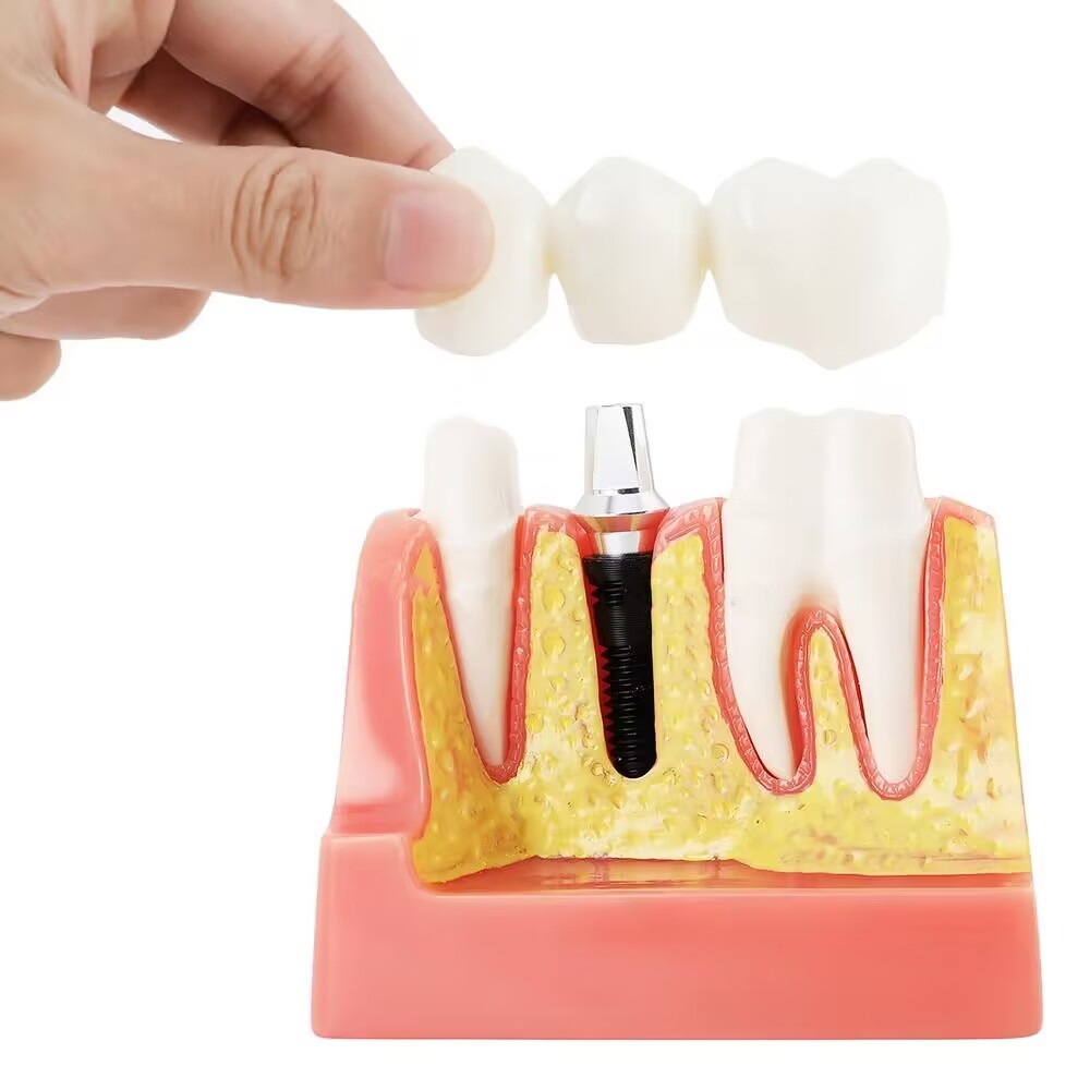 Dental 4 Times Implant Teeth model Analysis Crown Bridge Demonstration ...