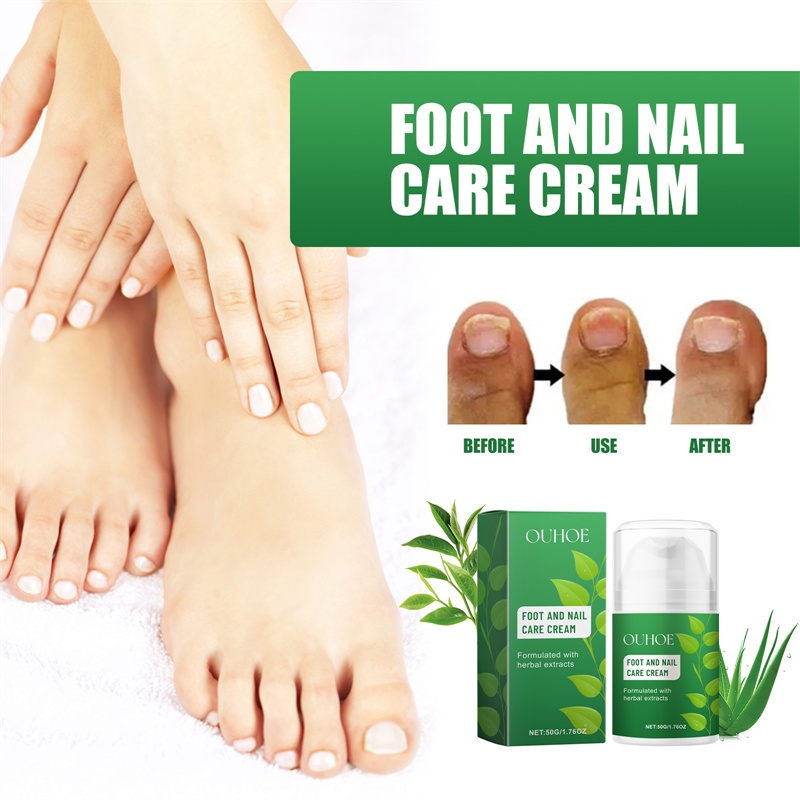 Nail Care Effective Treatments Cream Nail Fungus Removal Onychomycosis ...