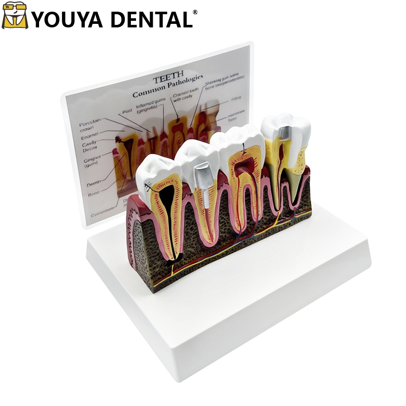 Dental Tooth Anatomical Model Dental Anatomy Teeth Model Oversized ...