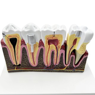 Dental Tooth Anatomical Model Dental Anatomy Teeth Model Oversized ...