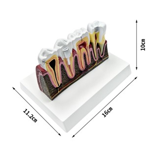 Dental Tooth Anatomical Model Dental Anatomy Teeth Model Oversized ...