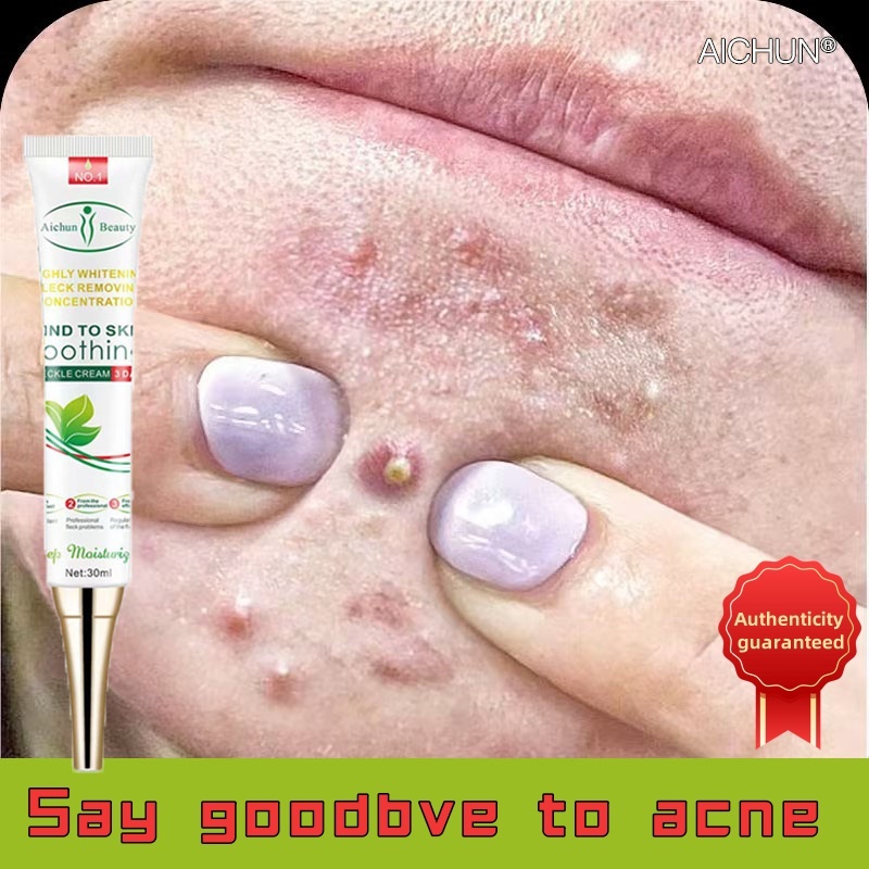【Genuine】Aichun acne scar ointment, redness, swelling, anti ...