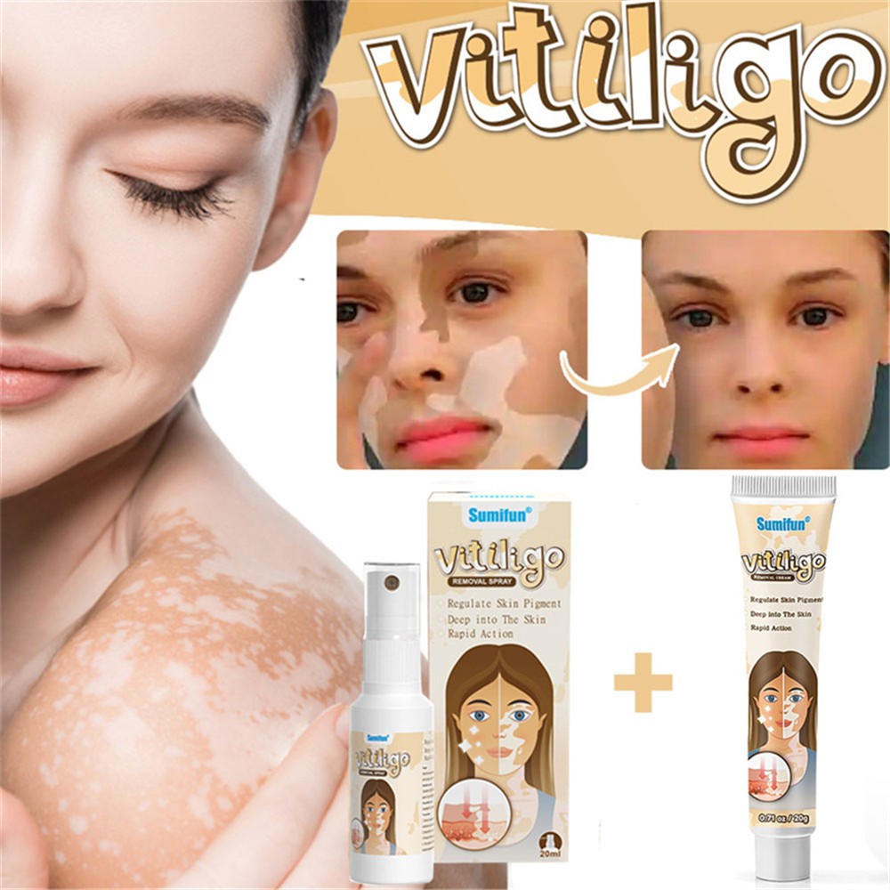 Effectively Remove Vitiligo Ointment Ringworm White Spot Removal Skin ...