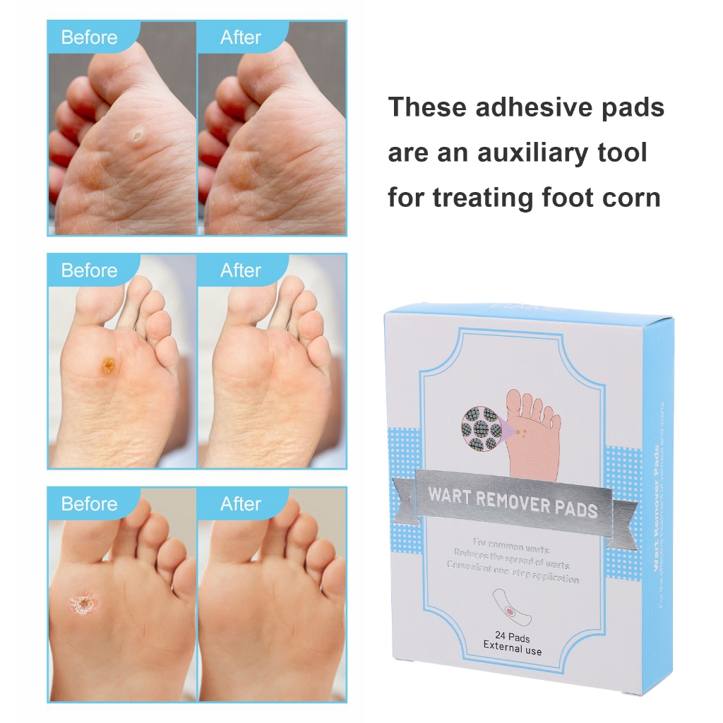 [READY STOCK] Remove Corns Stickers 24 Pcs Plantar Patches Feet Removal ...