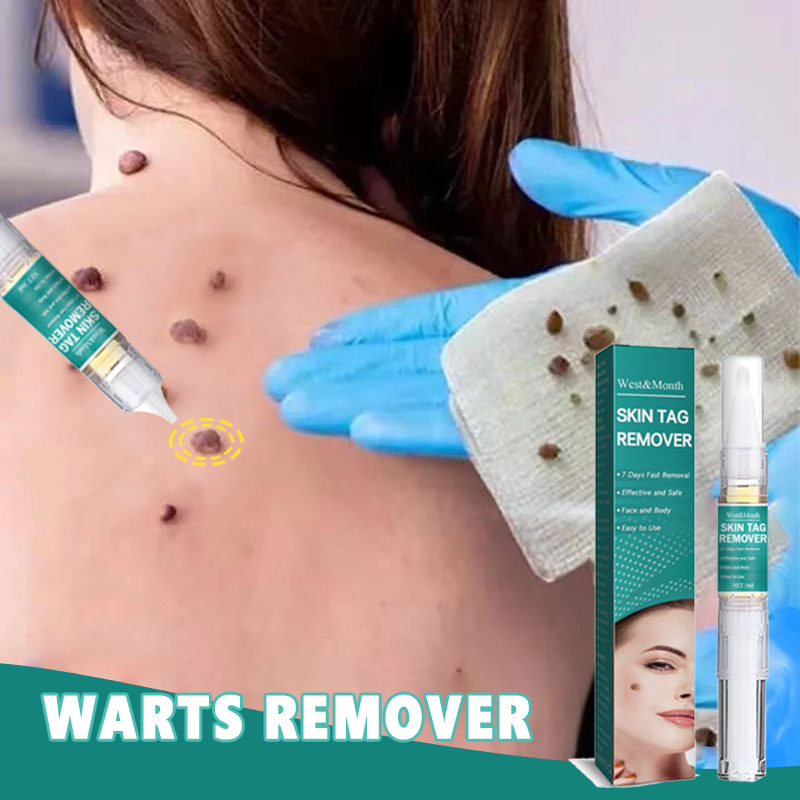 Warts Mole Remover Cream Original Machine Effective Warts Mole Removal ...