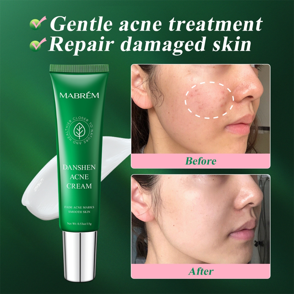 MABREM Acne Treatment Cream Skin Care Remove Acne Oil Whitening ...