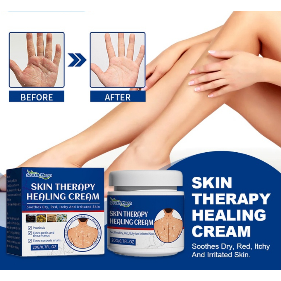 20g Skin Therapy Healing Cream Itch Relief Dermatitis Eczema Fungal ...