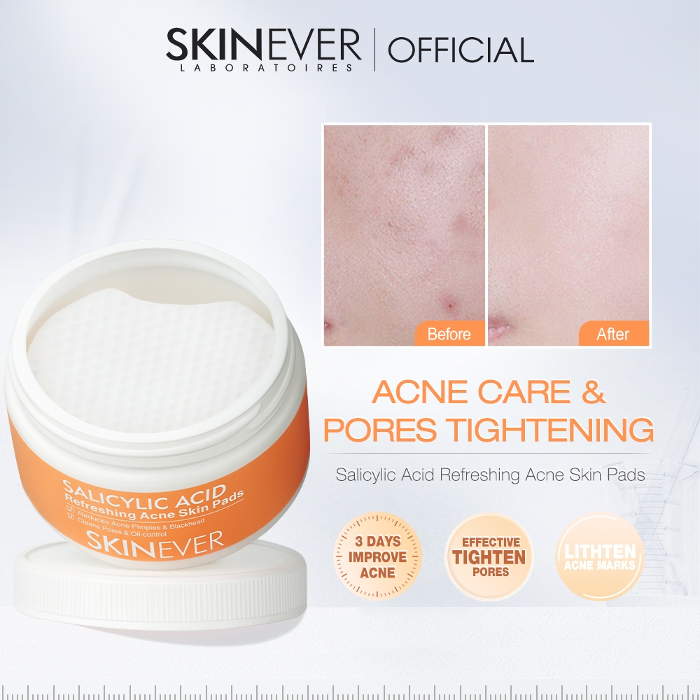 SKINEVER Salicylic Acid Acne Skin Pads Reduces Acne Pimples And ...