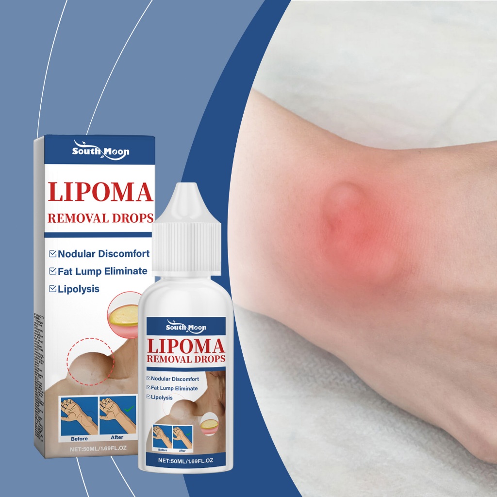 South Moon Lipoma Removal Drops Subcutaneous Lumps Treatment Lump ...