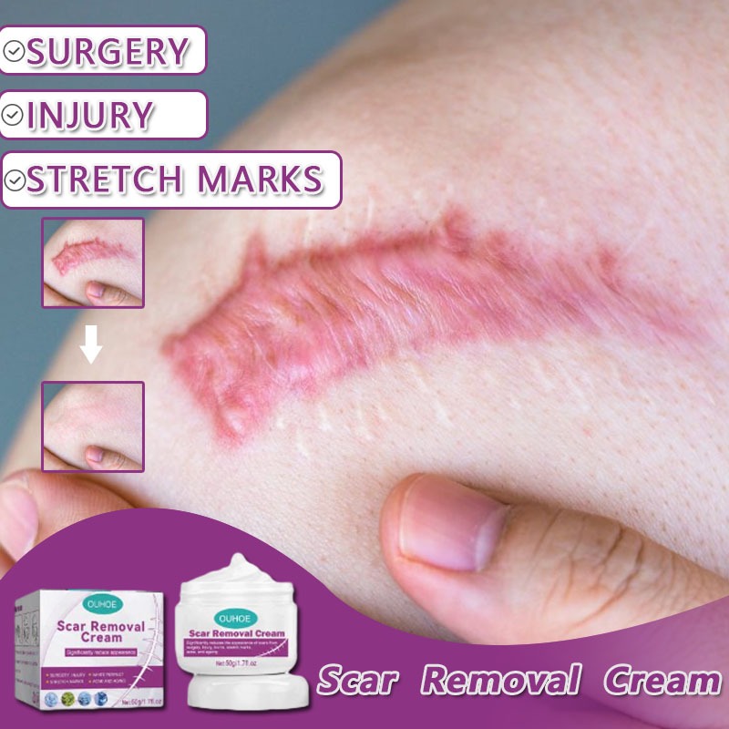 Scar Remover Cream Scar Repair Fade Scald Scar Fade Scars Burns Parut ...