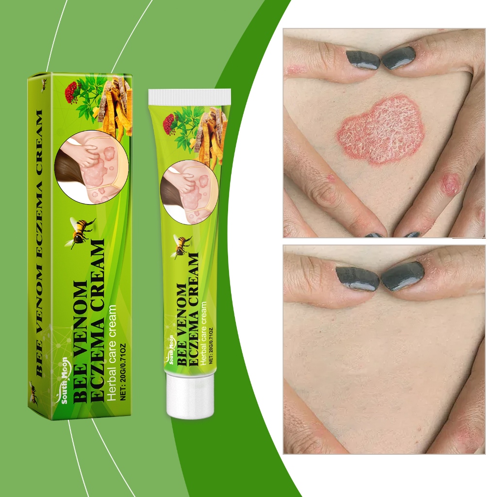 Bee Venom Eczema Ointment Treatment Foot Psoriasis Urticaria Skin ...