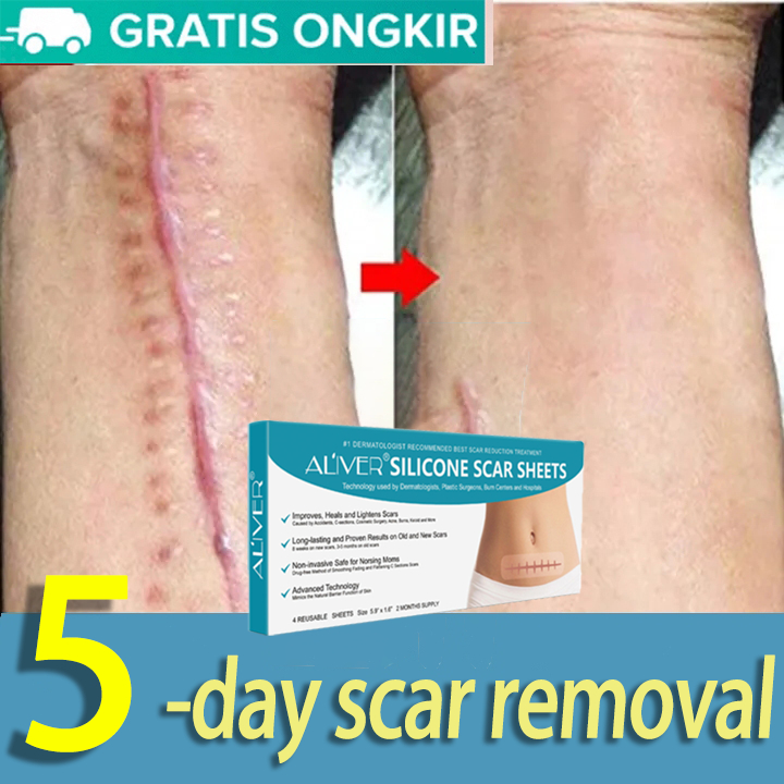 Aliver silicone scar removal sticker, softening and flattening surgery ...