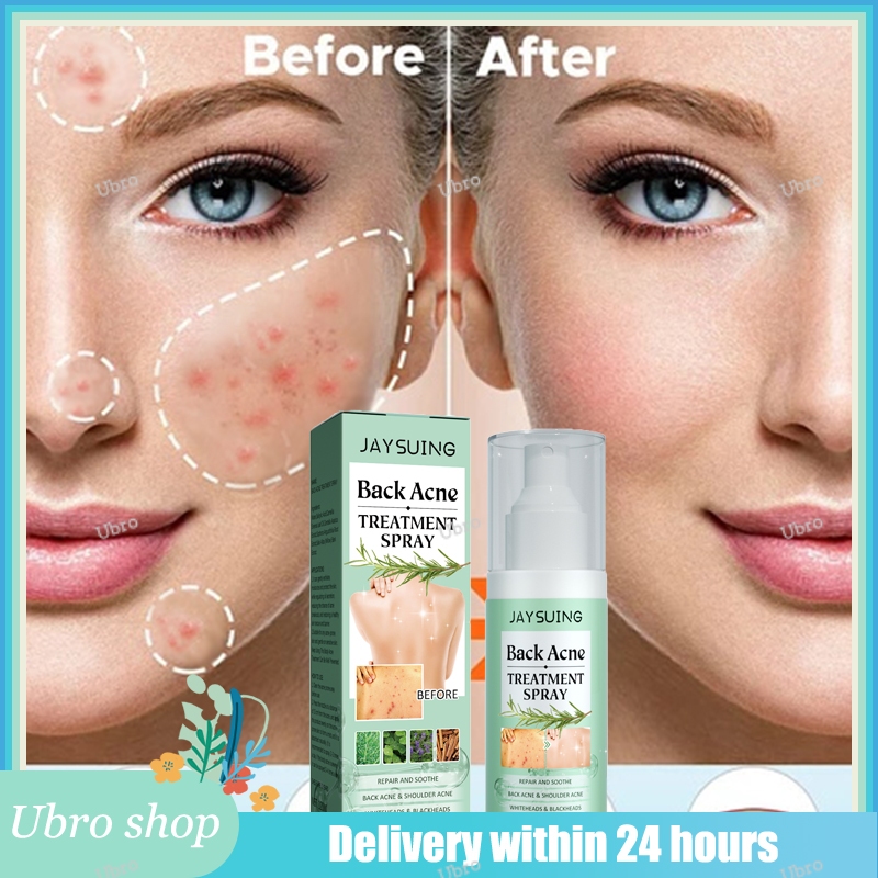 salicylic acid acne spray 2% spray for acne and pimples smooth skin ...