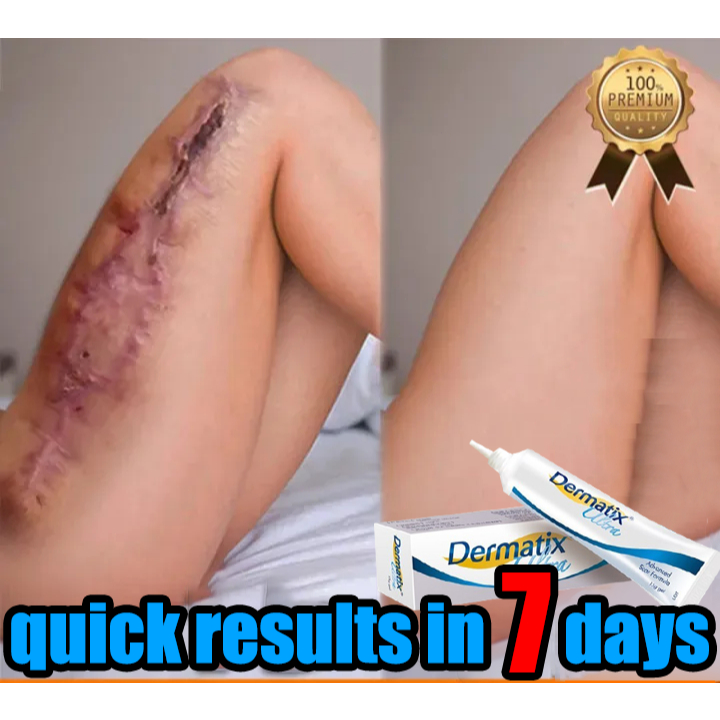 Australia Dermatix Scar Gel Acne Scars Treatment Scar Removal Cream ...