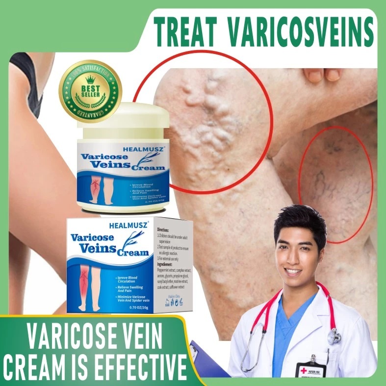 Varicose Veins Effective Remover Cream Spider Vein Pain Killer Cream ...