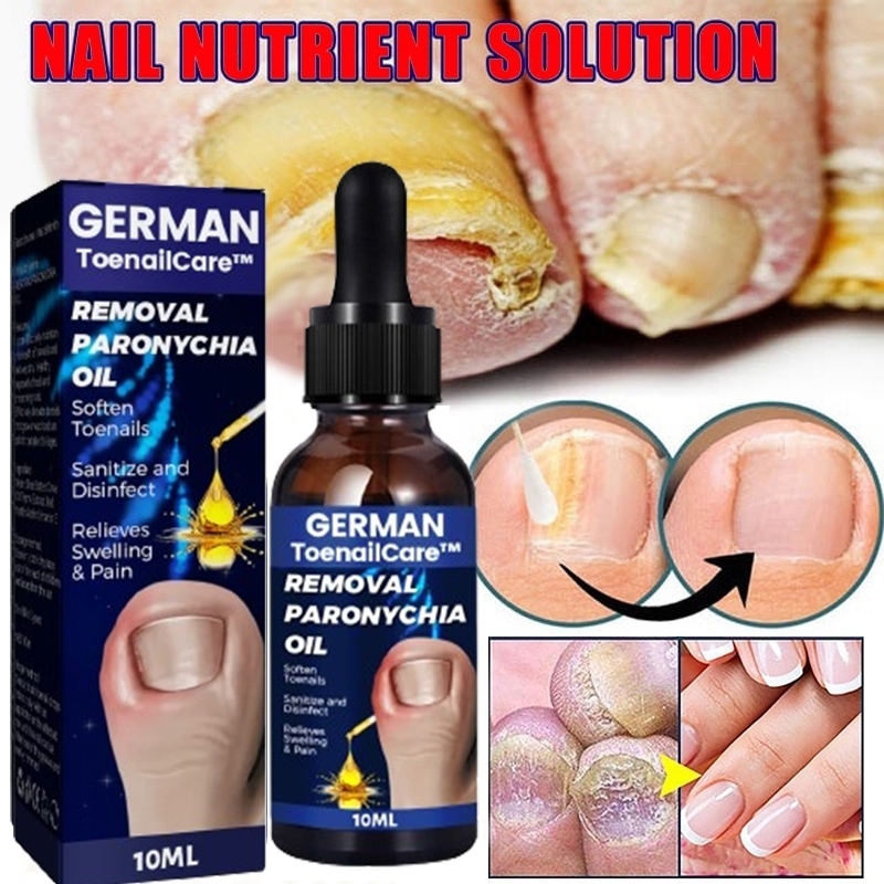10ml Paronychia Removal Oil Toenailcare Removal Paronychia Ingrown ...