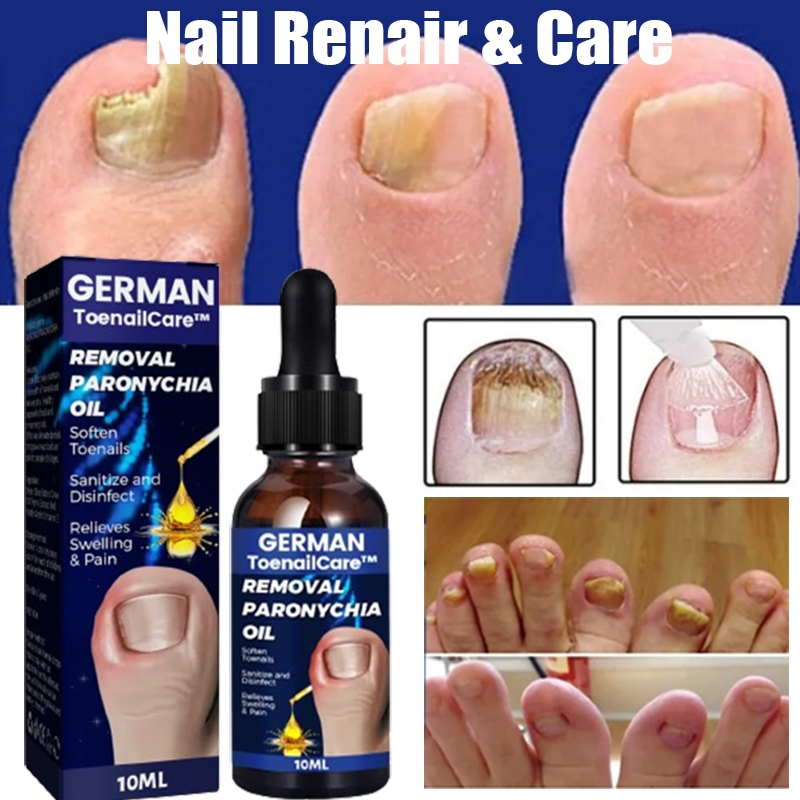 10ml Toenailcare Removal Paronychia Ingrown Toenail Nail Repair ...