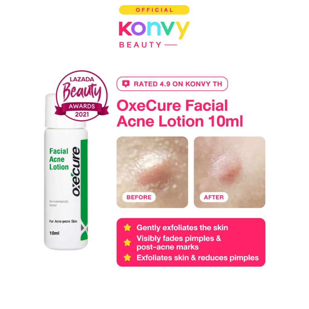 OxeCure Facial Acne Lotion 10ml (For Acne-Prone Skin; Pimples ...