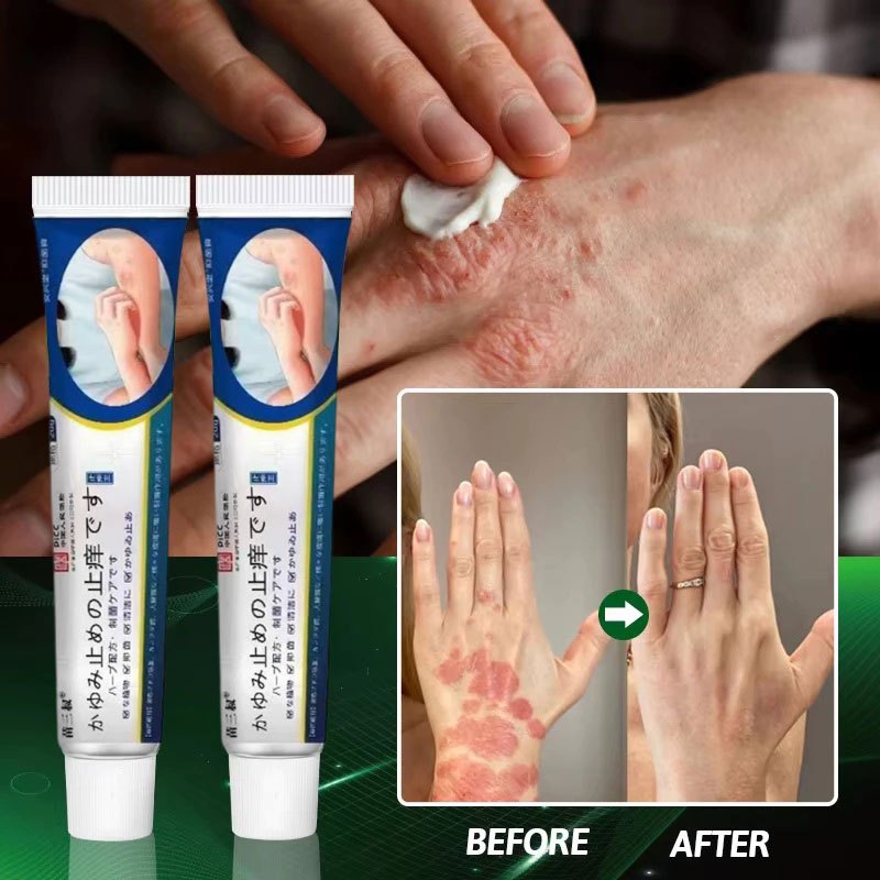 Japanese Premium Anti-Itching King Powerful Anti-Itching King Dry and itchy skin all over the ...