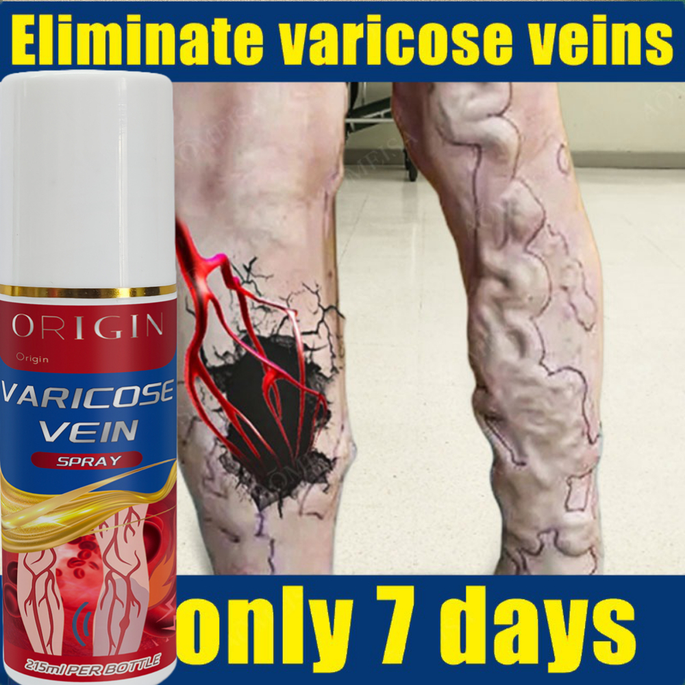 215ml Varicose Vein Spray Vein Healing Varicose Vein Spray for Legs ...