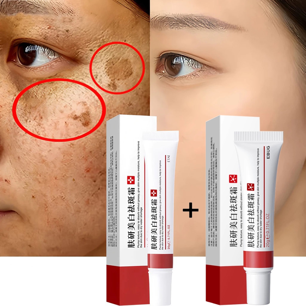 Freckle Cream, Acne Scar Removal Treatment Cream, Pigmentation Removal ...