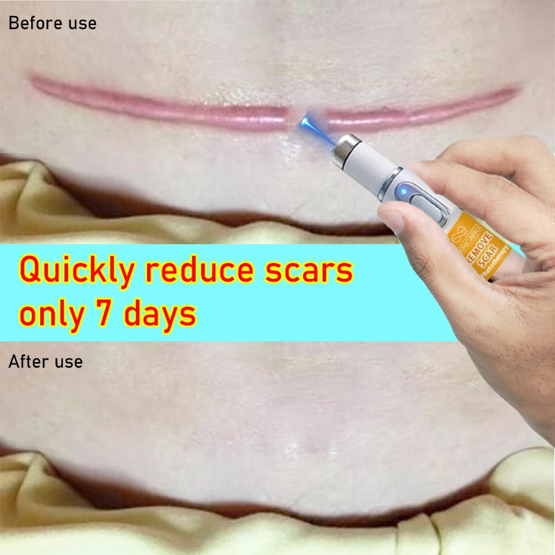 Home scar removal laser pen, lightens scars, says goodbye to scar ...