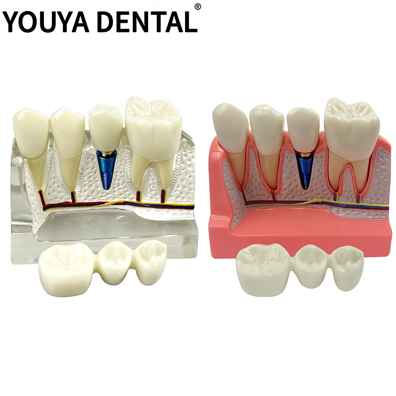 Dental Implant Teach Crown Bridge Removable Model Porcelain Teeth Model ...
