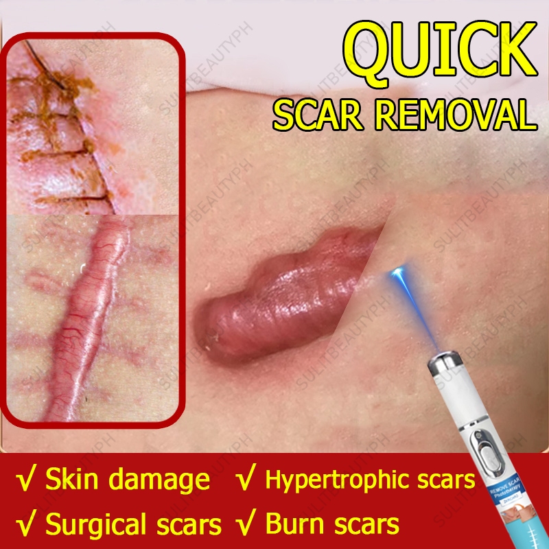 Scar removal laser pen Quickly remove old scars, scar hyperplasia ...