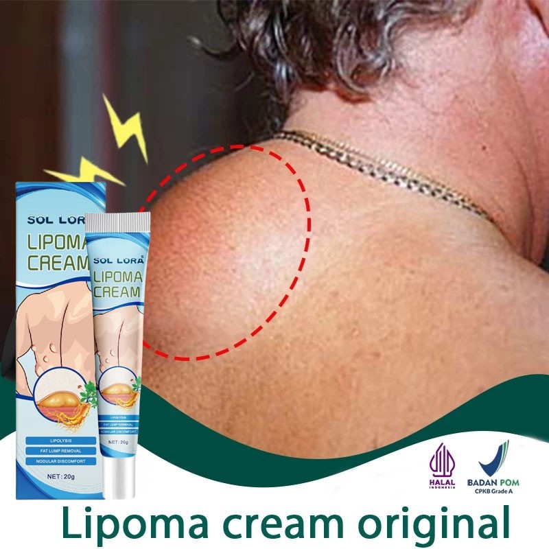 Lipoma Removal Cream Treat Tumor Skin Swelling Ointment Herbal 20g cyst ...