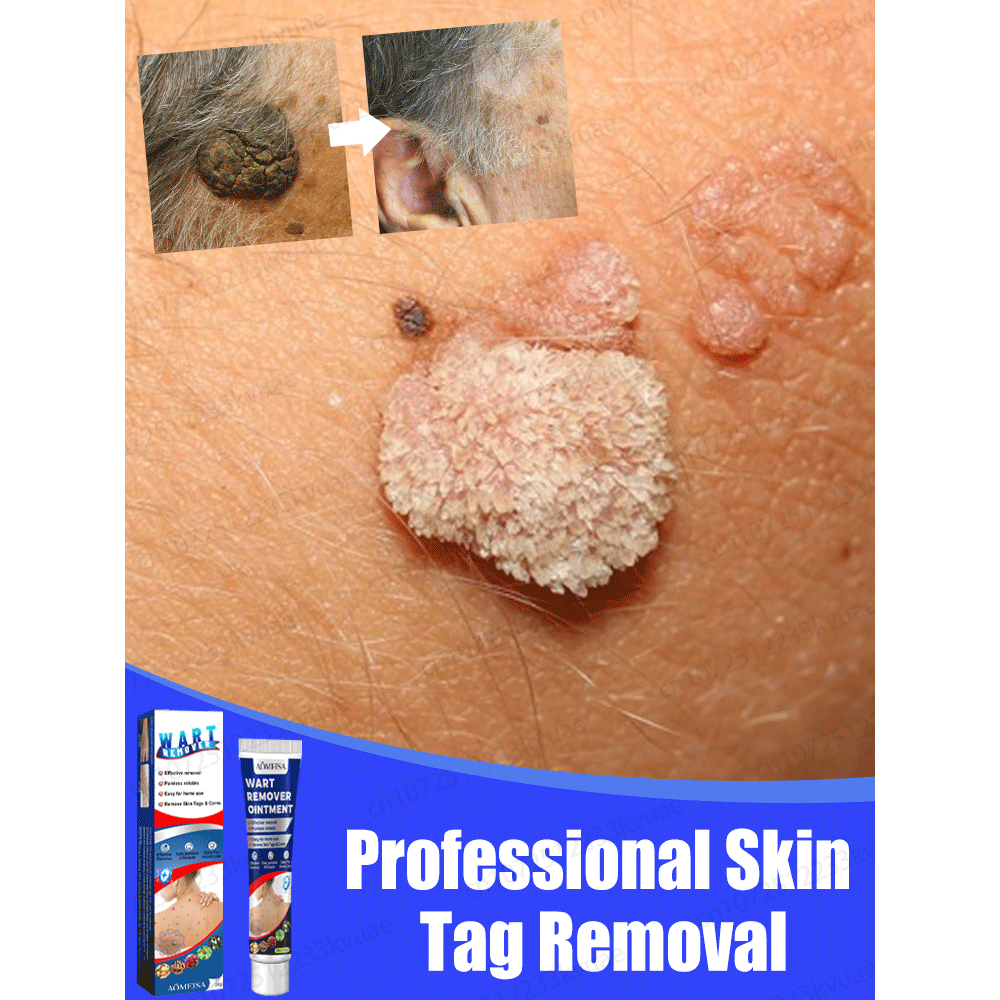 Wart removal cream, skin tag removal, freckles, melanin spots removal ...