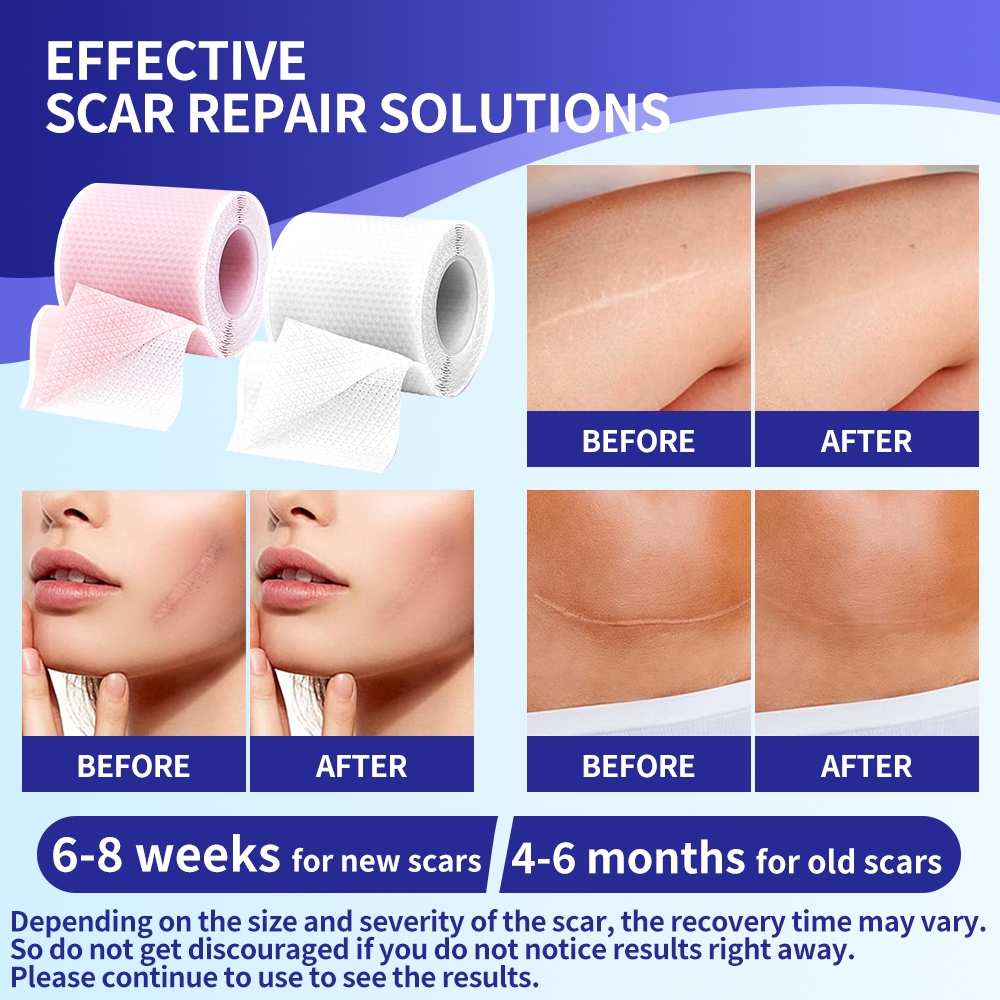 Silicone Scar Tape Self-adhesive Wrinkle Patch Scars Removal Surgical ...